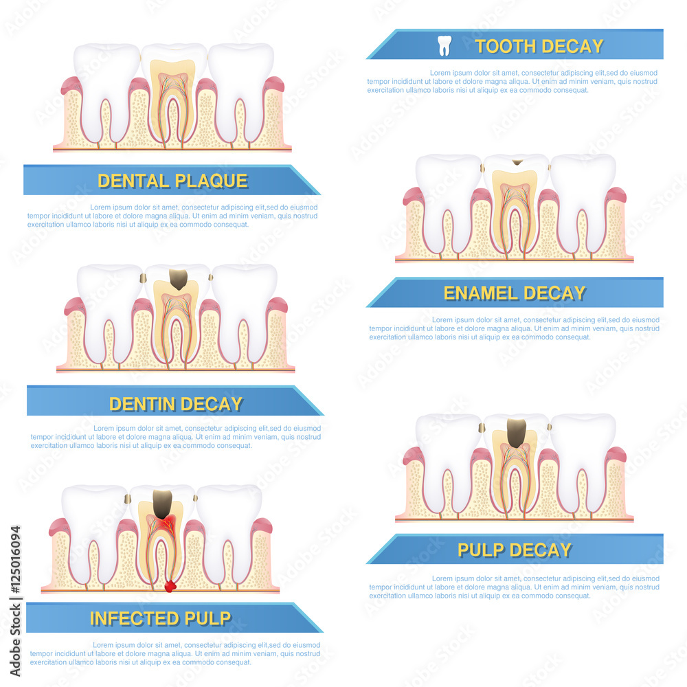 infographic dental caries, stages of tooth decay Stock Vector | Adobe Stock