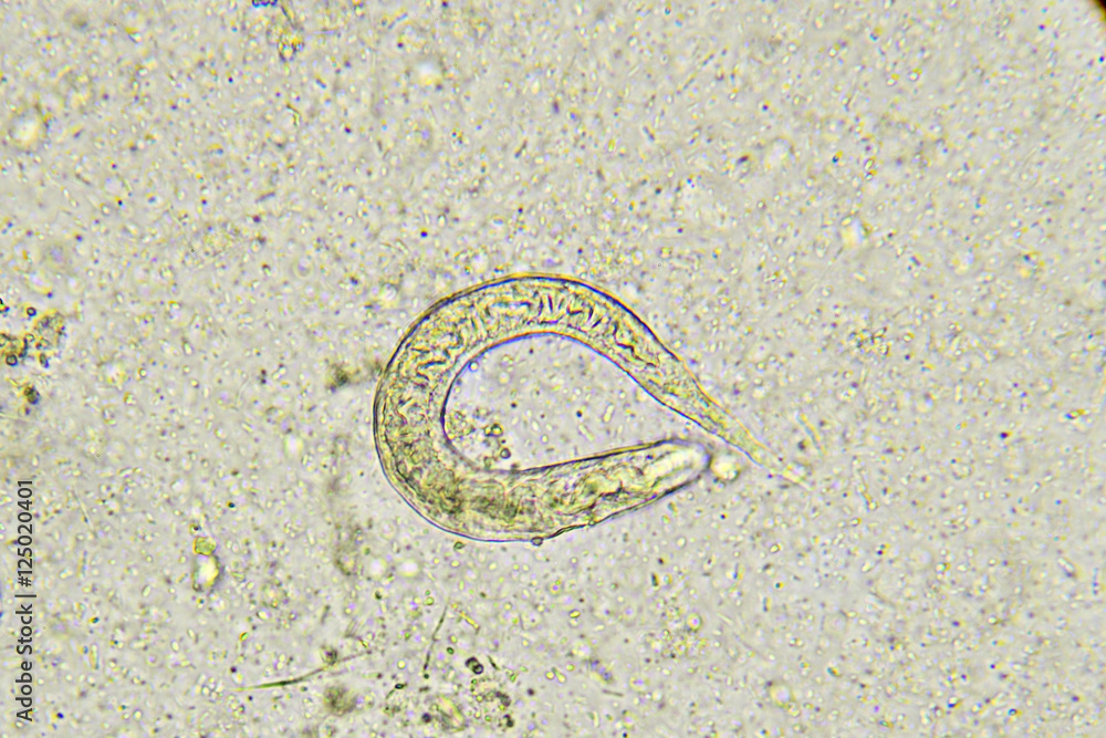 Strongyloides stercoralis (threadworm) in stool, analyze by microscope ...