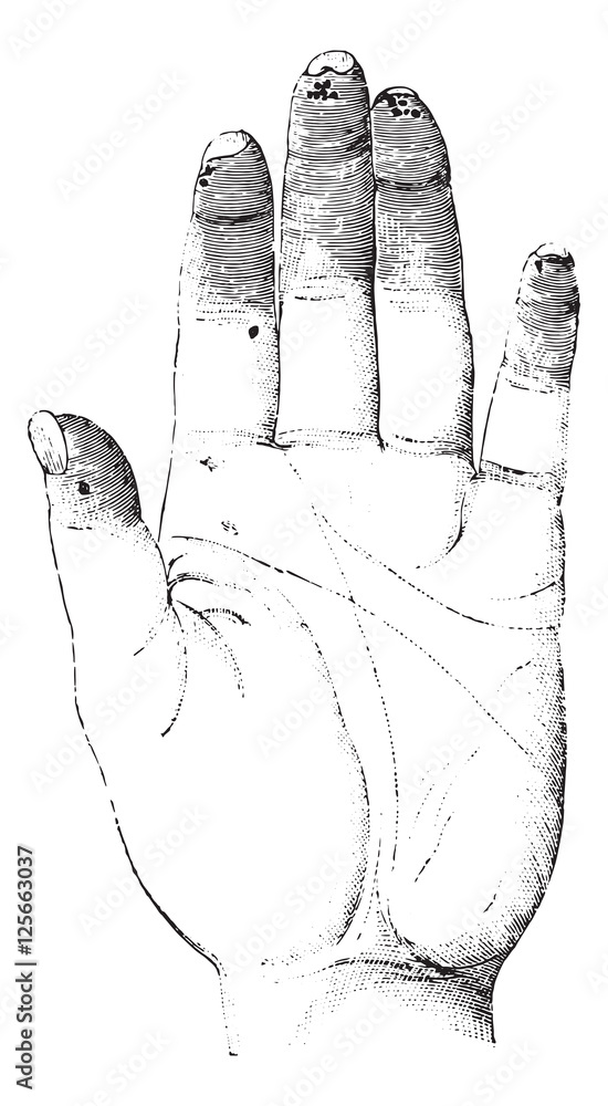 Sclerosis or Sclerotizis of the left hand (palmar surface), vint Stock ...