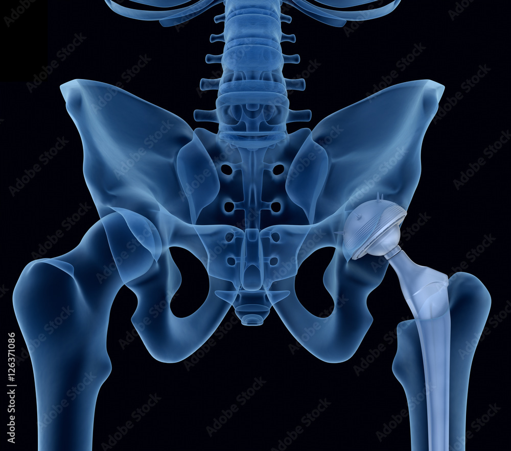 Hip replacement implant installed in the pelvis bone. X-ray view ...