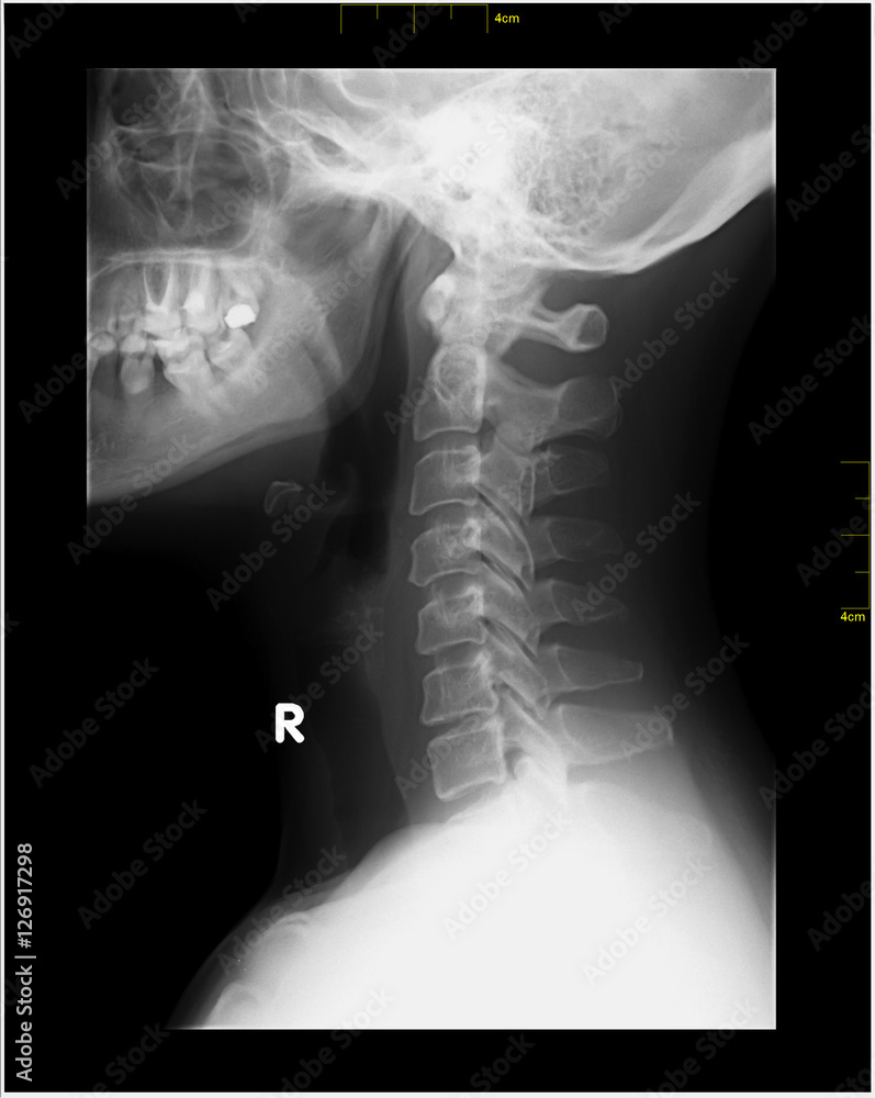 X-ray of the neck - inversion of cervical lordosis, reduced disc height ...