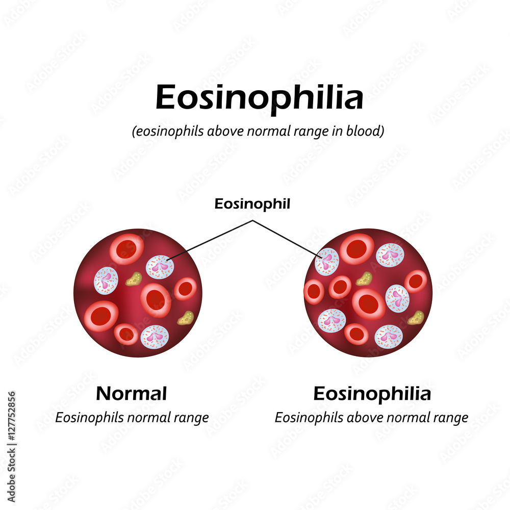 Eosinophils above normal range in blood. Eosinophilia. Infographics ...