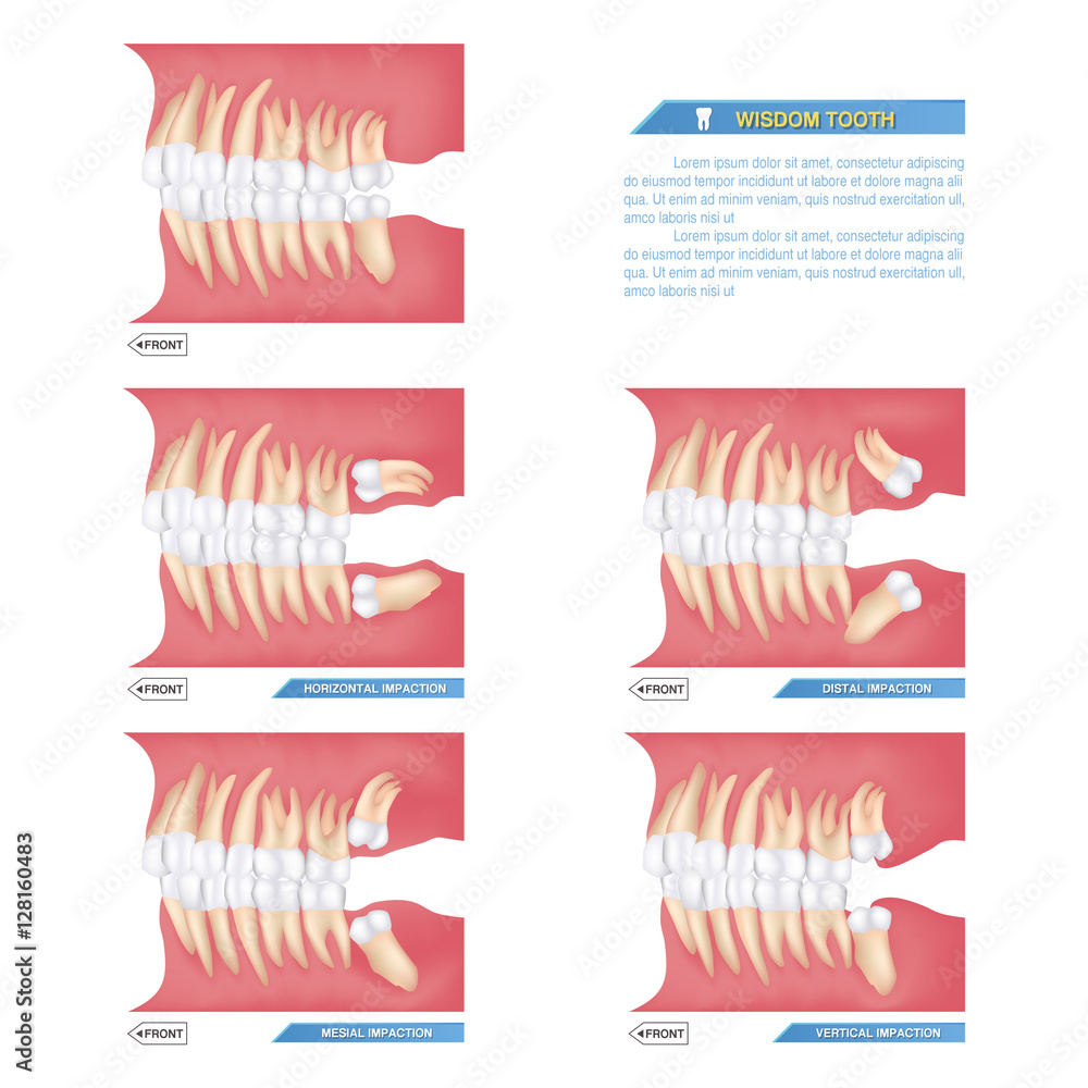 set of impacted wisdom tooth, dental problems, horizontal, mesial ...