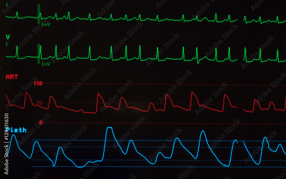 Close up of a medical monitor with green lines of ECG showing atrial ...