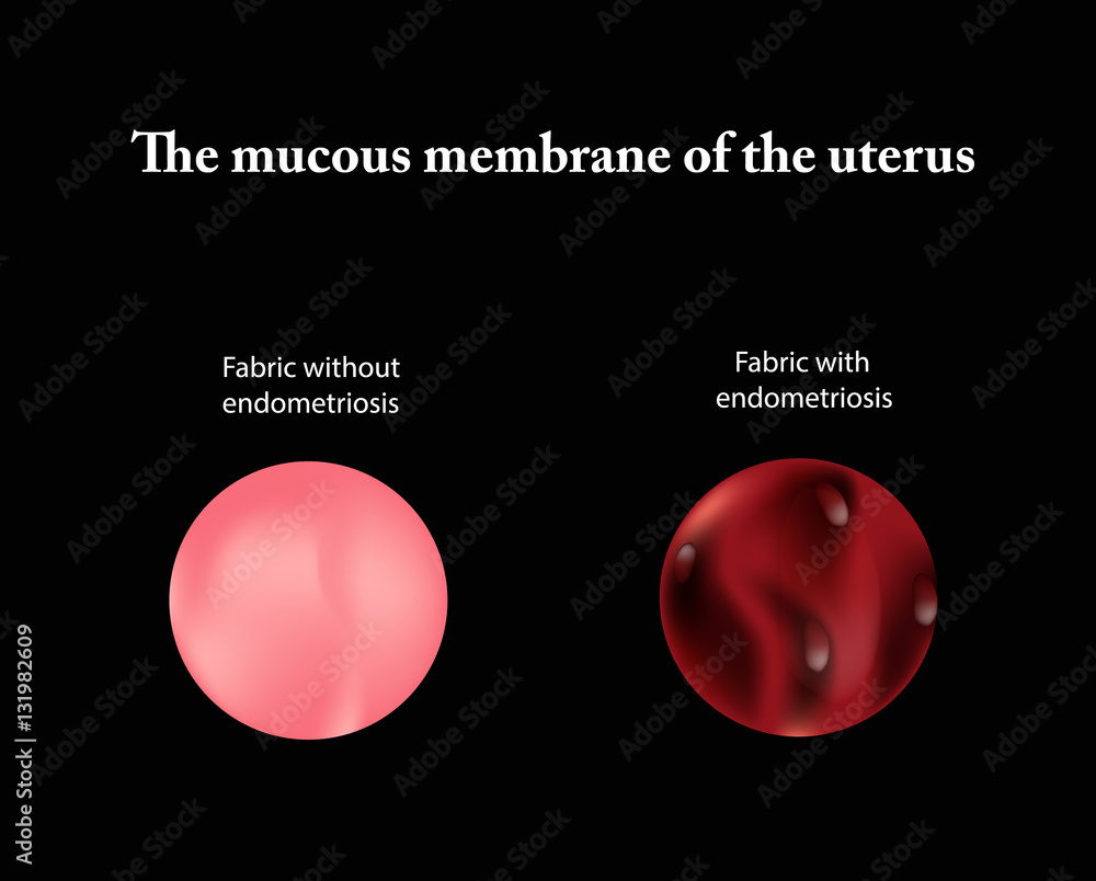 Endometriosis. The structure of the pelvic organs. Adenomyosis. The ...