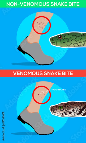 Venomous and non venomous snake bite in the leg. Snakebite. Beware of ...