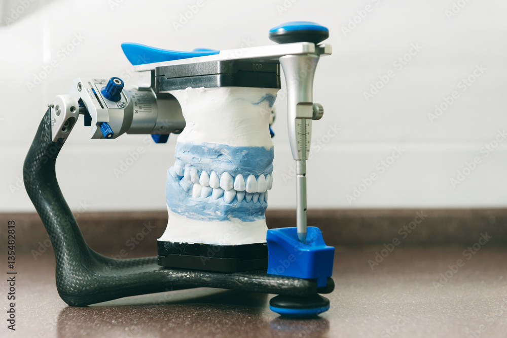 plaster cast of teeth with removable partial denture; showcasing Stock ...