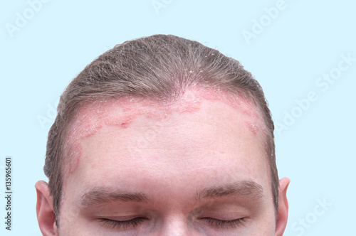 Red psoraitic spot on hairline. Dermatological disease, stress ...