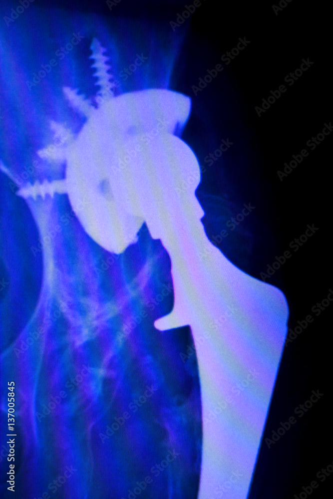 Hip replacement implant Xray scan Stock Photo | Adobe Stock