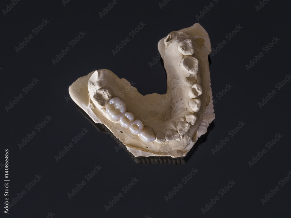 Monolithic zirconia restorations implant supported with the ceramic ...