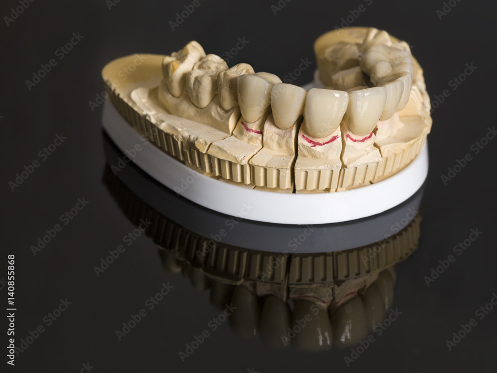 Monolithic zirconia restorations implant supported with the ceramic ...