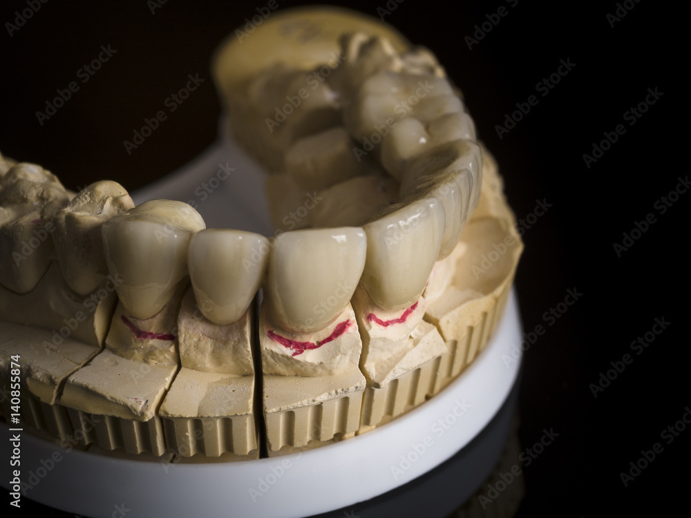 Monolithic zirconia restorations implant supported with the ceramic ...