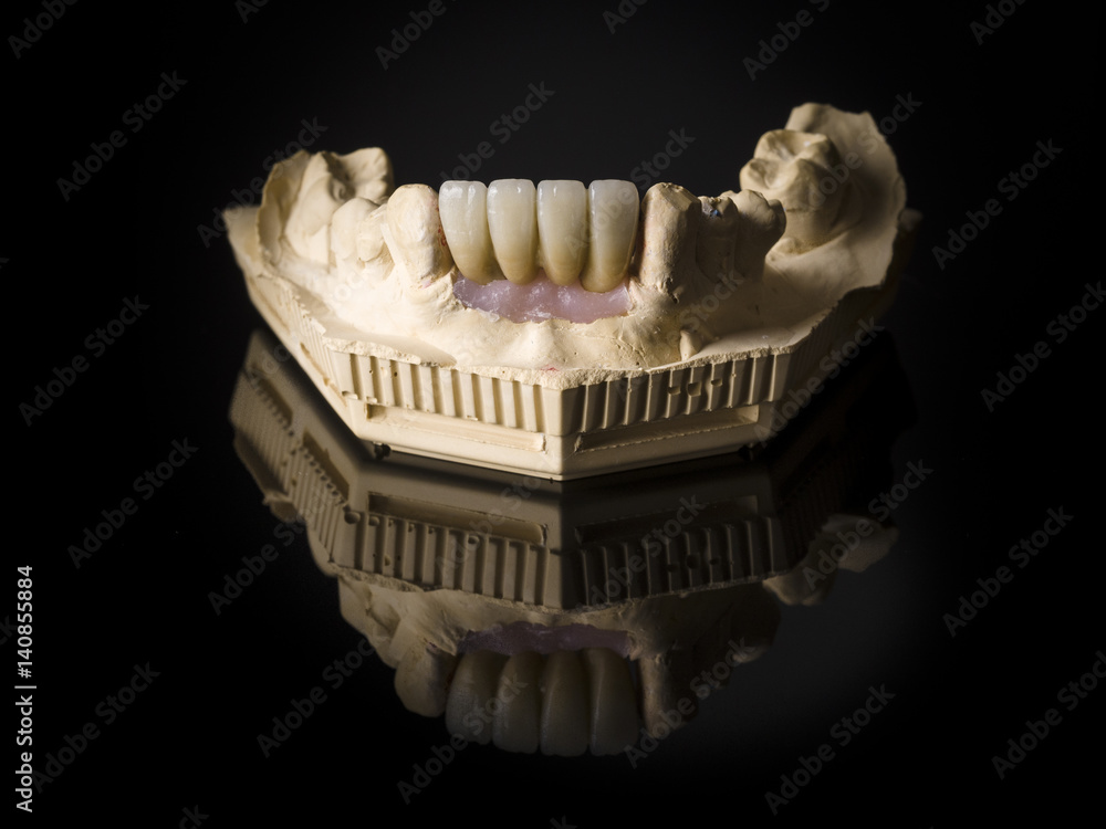 Monolithic zirconia restorations implant supported with the ceramic ...