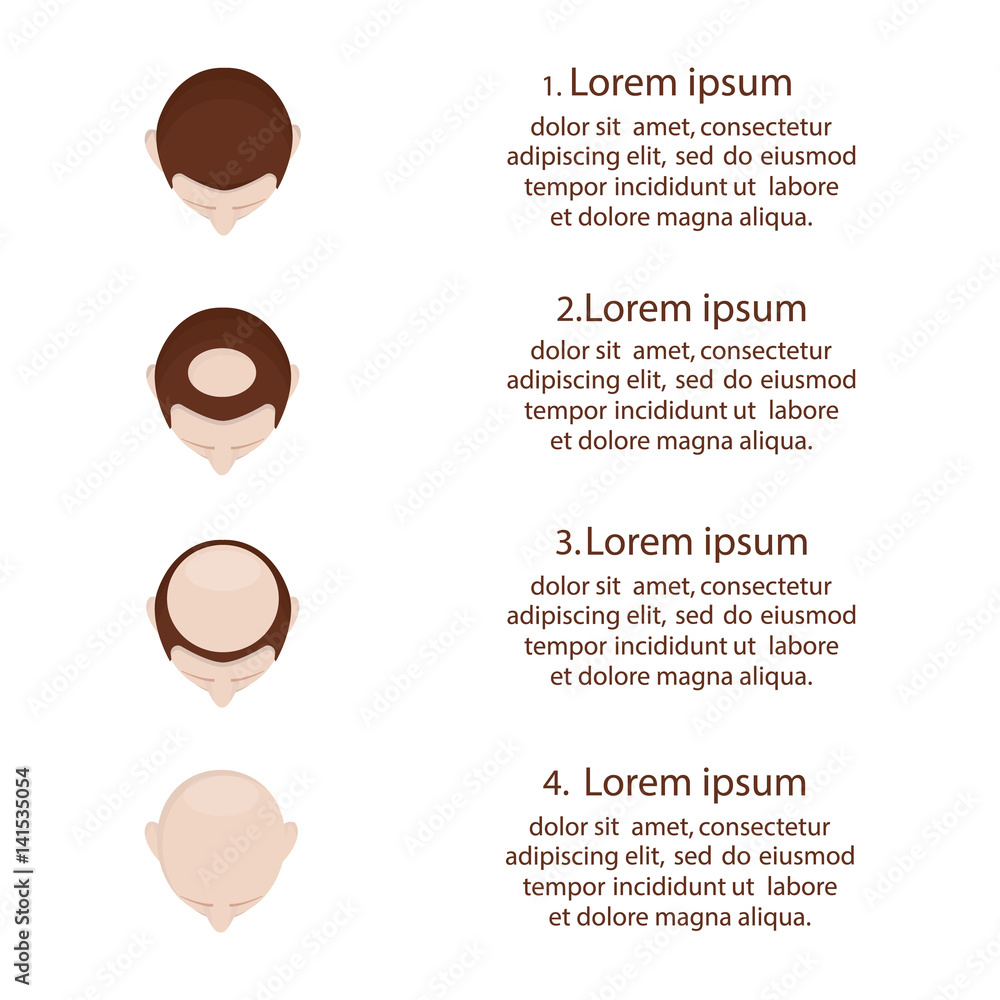 Modern vector illustration of baldness. Hair loss stages set. Different ...