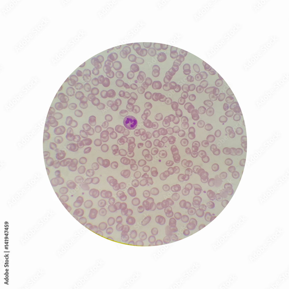 Blood smear under microscope present neutrophil, abnormal red blood ...