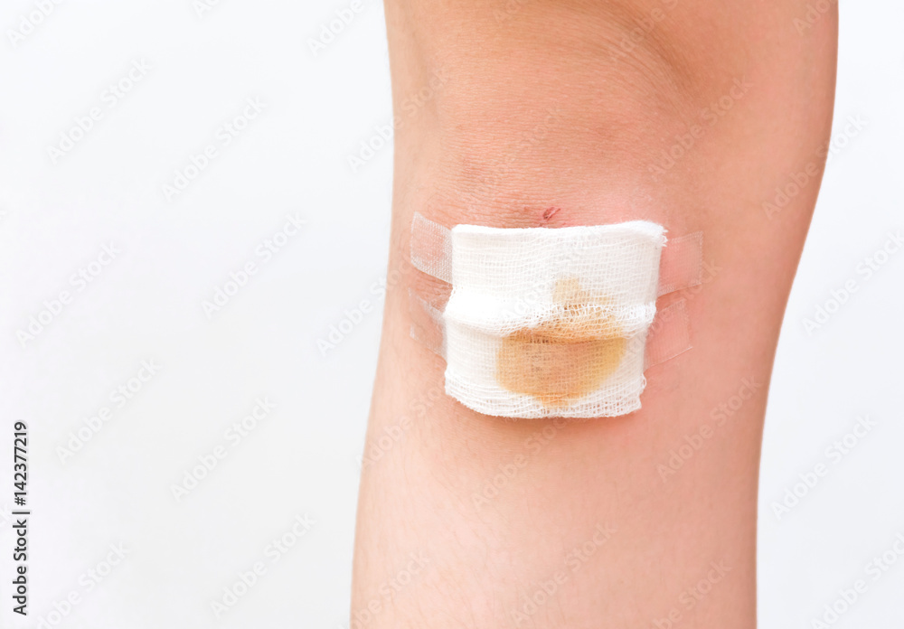 Wound at the knee caused by the fall. After cleaning and medicine is ...