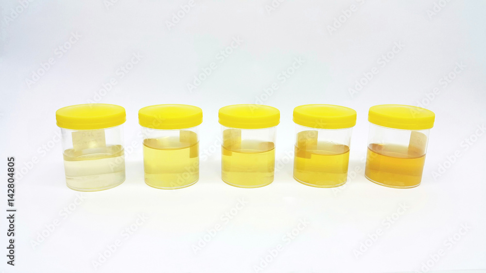 Urine in plastic container. Normal urine color range is pale yellow to ...