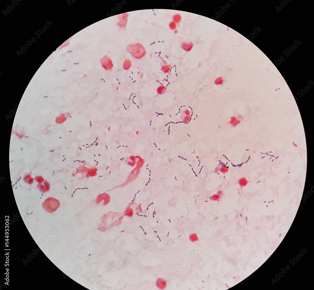 Smear of human blood culture Gram's stained with gram positive cocci in ...