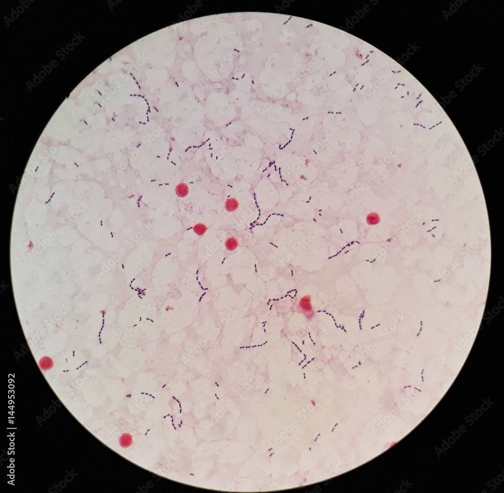 Smear of human blood culture Gram's stained with gram positive cocci in ...