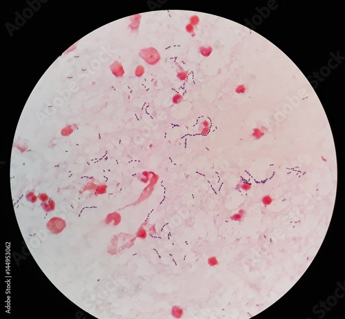 Smear of human blood culture Gram's stained with gram positive cocci in ...