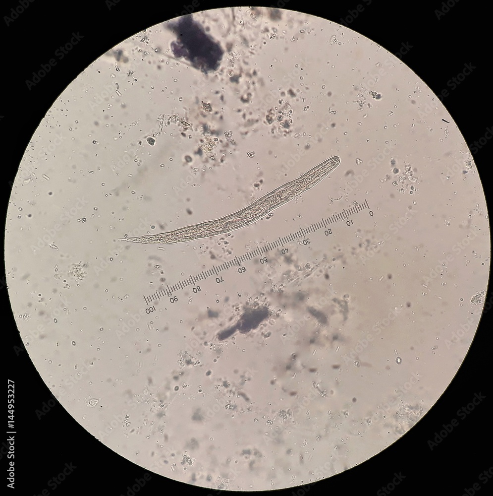 Parasite in stool under 40X light microscopy; Strongyloides stercoralis ...