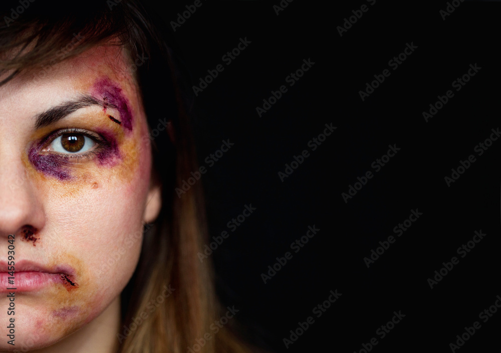 Beaten young woman with bruises on her face. Abuse, violence, close up ...