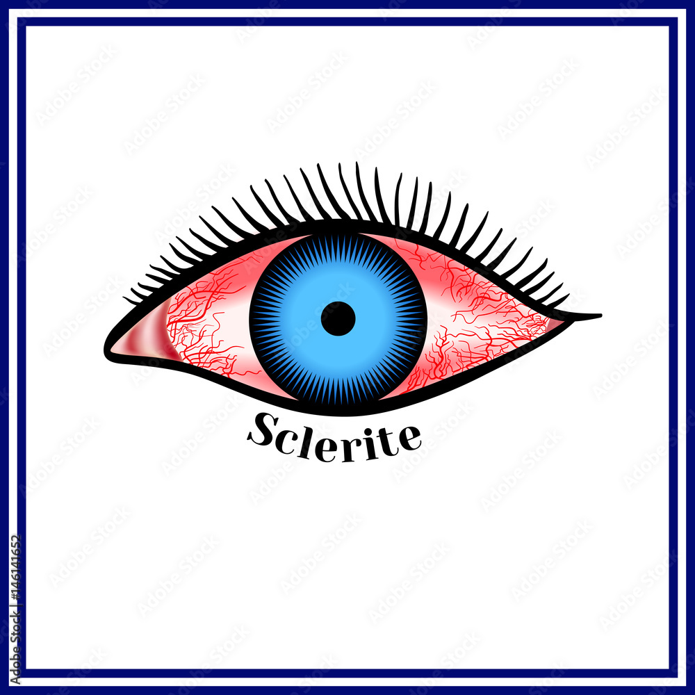 Sclerite. Inflammatory disease of sclera. Stock Vector | Adobe Stock