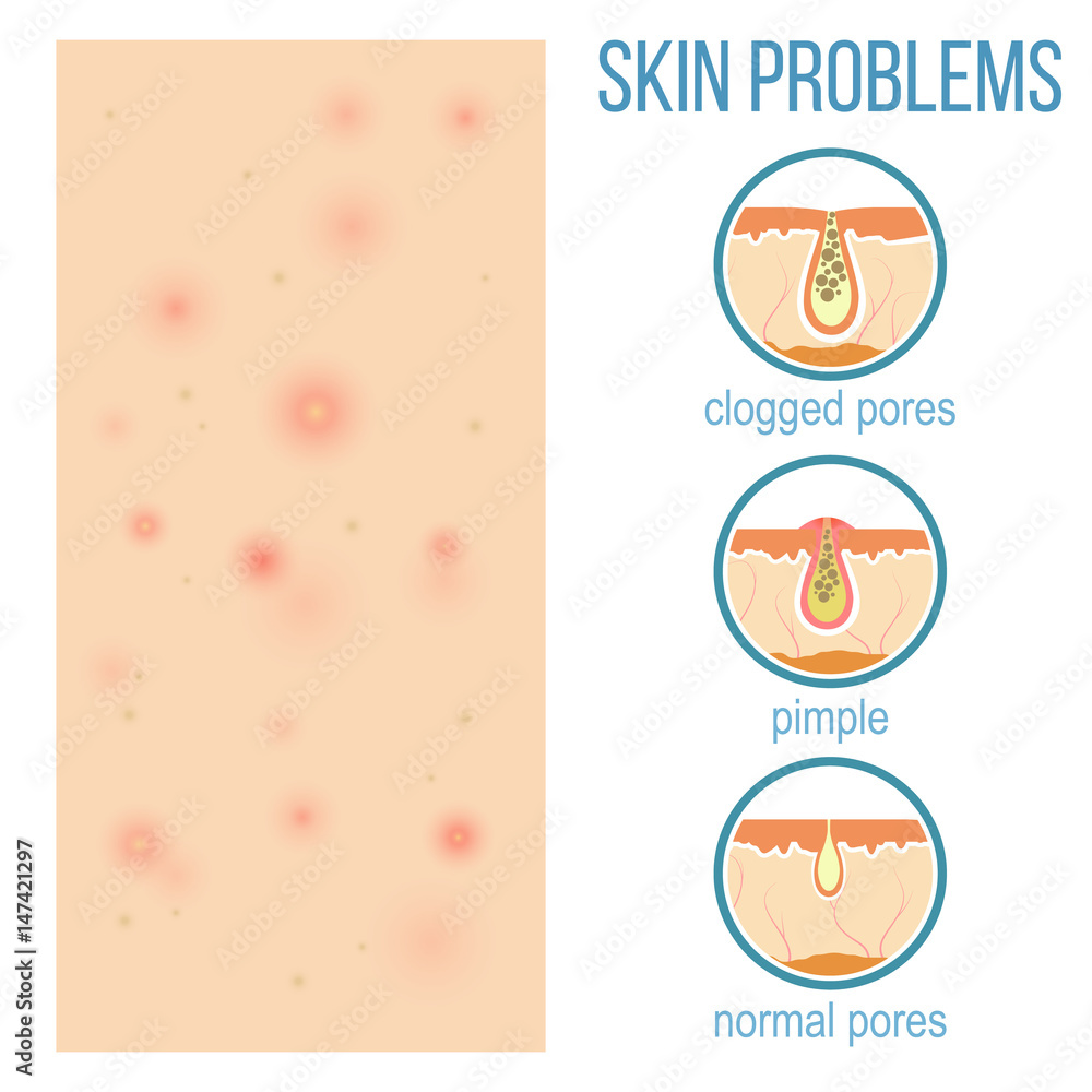 Skin problems such as acne, pimples and clogged pores. Top view of skin ...