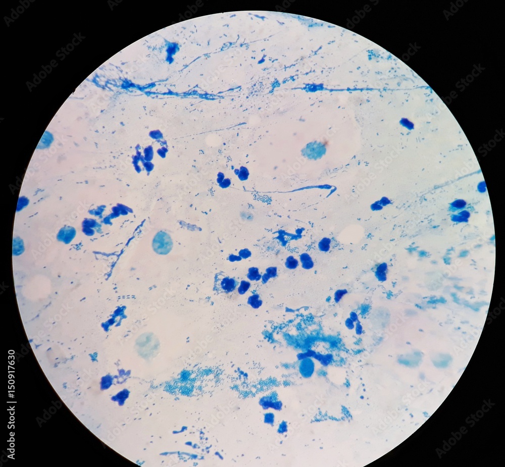 Photo Stock Smear of Acid-Fast bacilli (AFB) stained from sputum ...