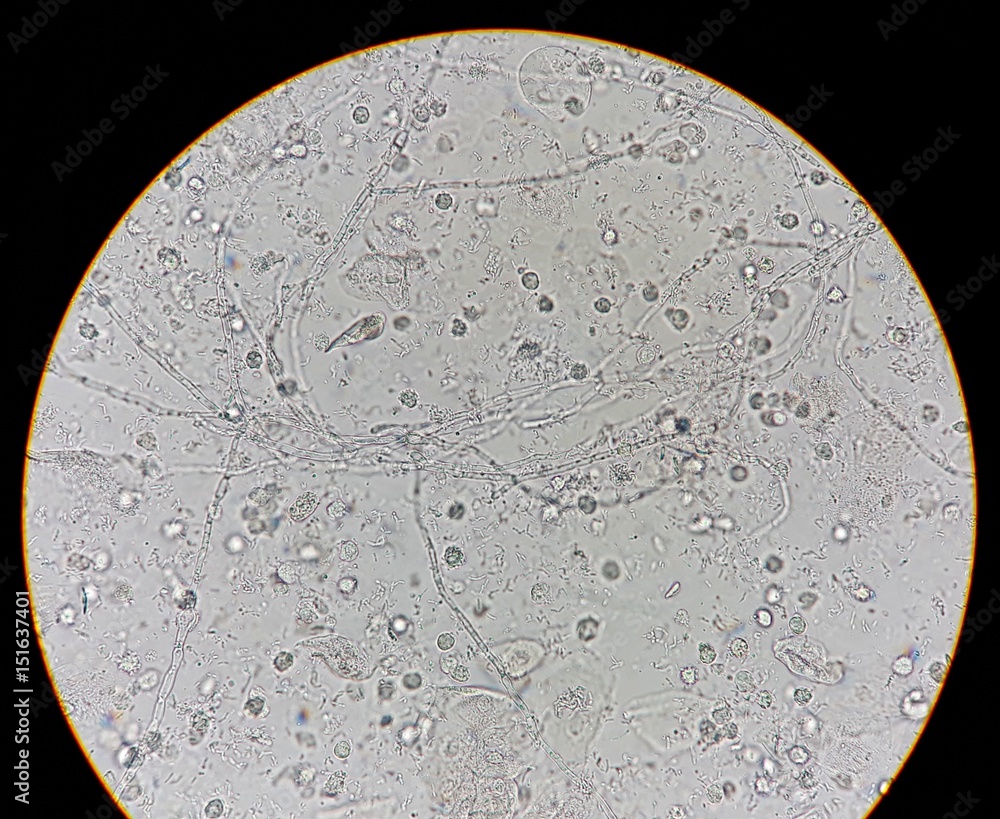 Abnormal result of urinalysis examination from microscopic method under ...