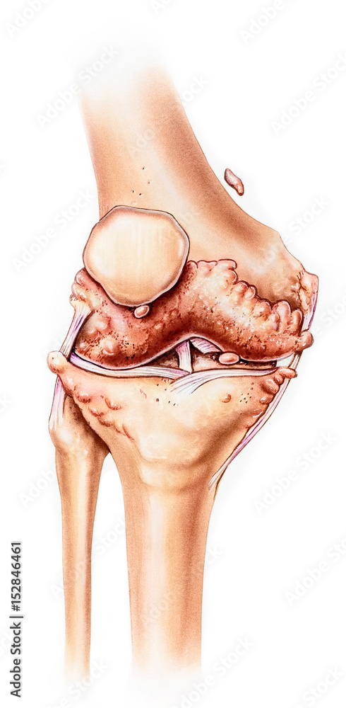 Illustration Stock Osteoarthritis of the human knee, front view. Shown ...