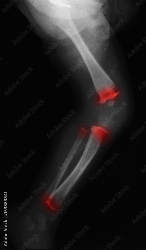 Congenital syphilis: forearm xray of newborn Stock Photo | Adobe Stock