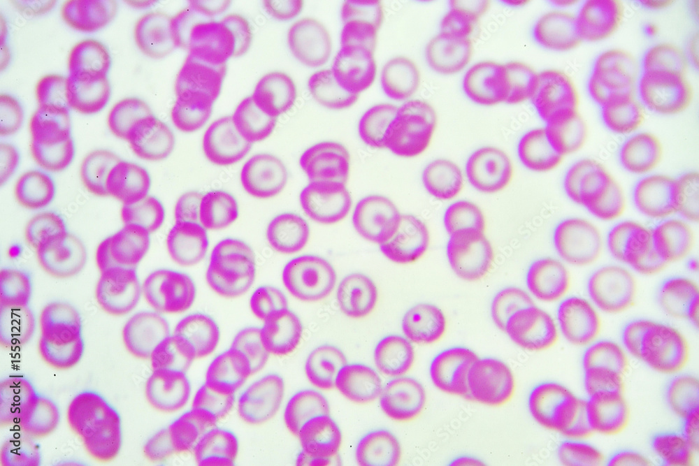 Abnormal red blood cells from anemia patient Stock Photo | Adobe Stock