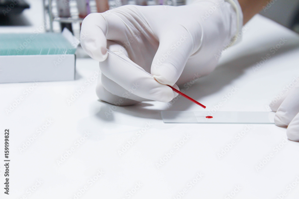 sample for blood smear method Stock Photo | Adobe Stock