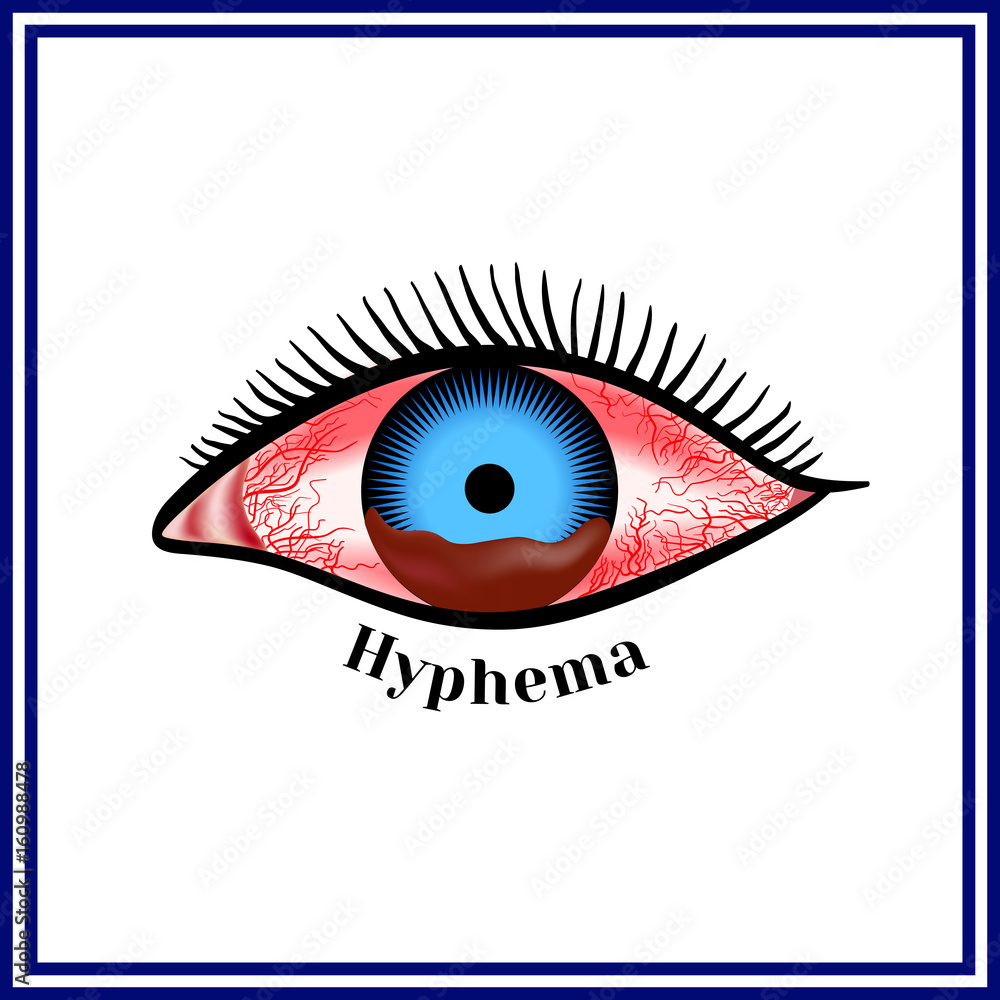 Hyphema - hemorrhage in the anterior chamber of the eye. Stock Vector ...