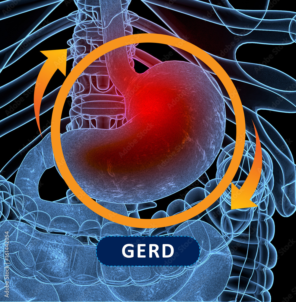 Acid reflux, GERD. Gastroesophageal reflux disease. Diagram with title ...