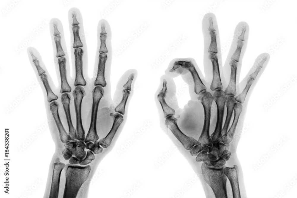 X-ray both hands with OK sign Stock Photo | Adobe Stock