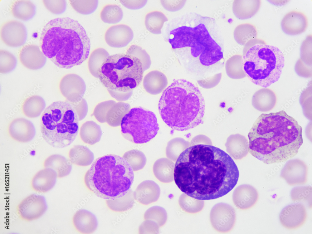 White blood cells in in blood smear, analyze by microscope Stock Photo ...