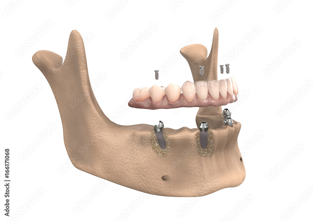 Dental anatomy - Lower teeth denture with bone structure and dental ...