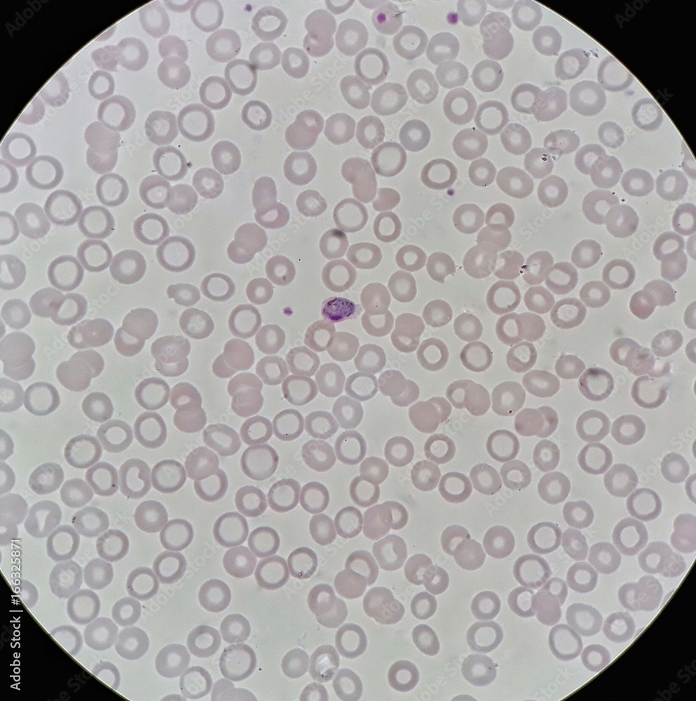 Under 100X light microscope, human parasite on thin film of blood smear ...