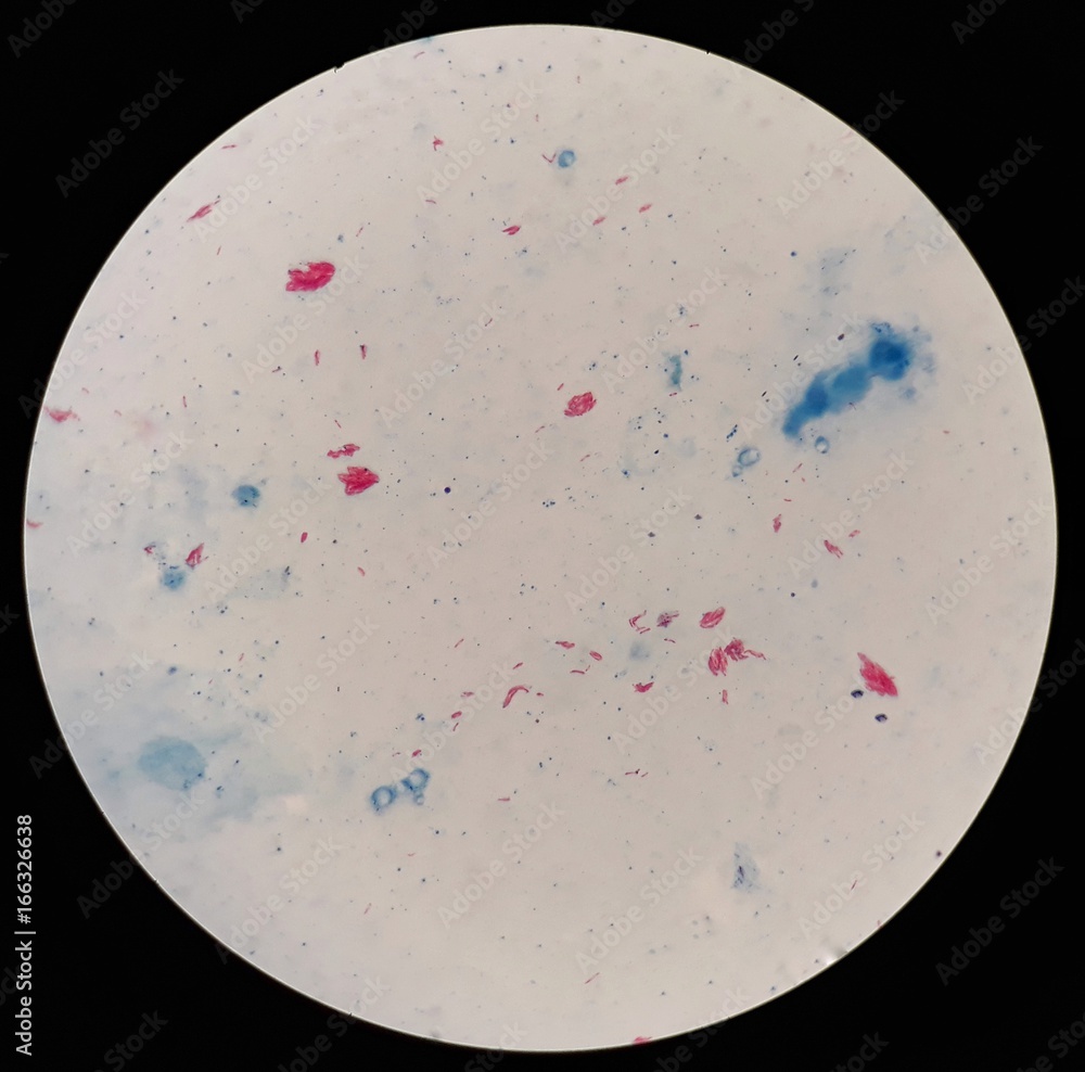 Smear of Acid-Fast bacilli (AFB) stained from cultured specimen with positive Mycobacterium ...