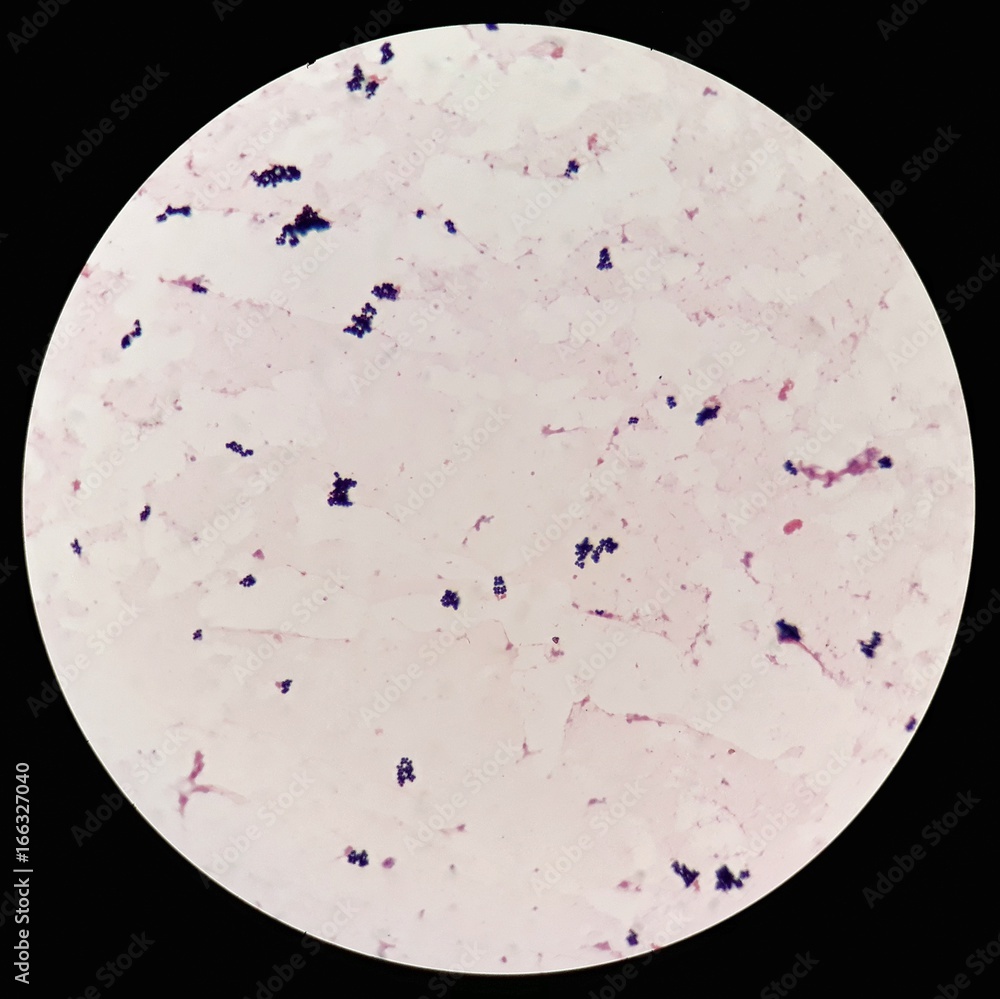 Stock-Foto „Smear of human blood cultured Gram's stained with gram ...