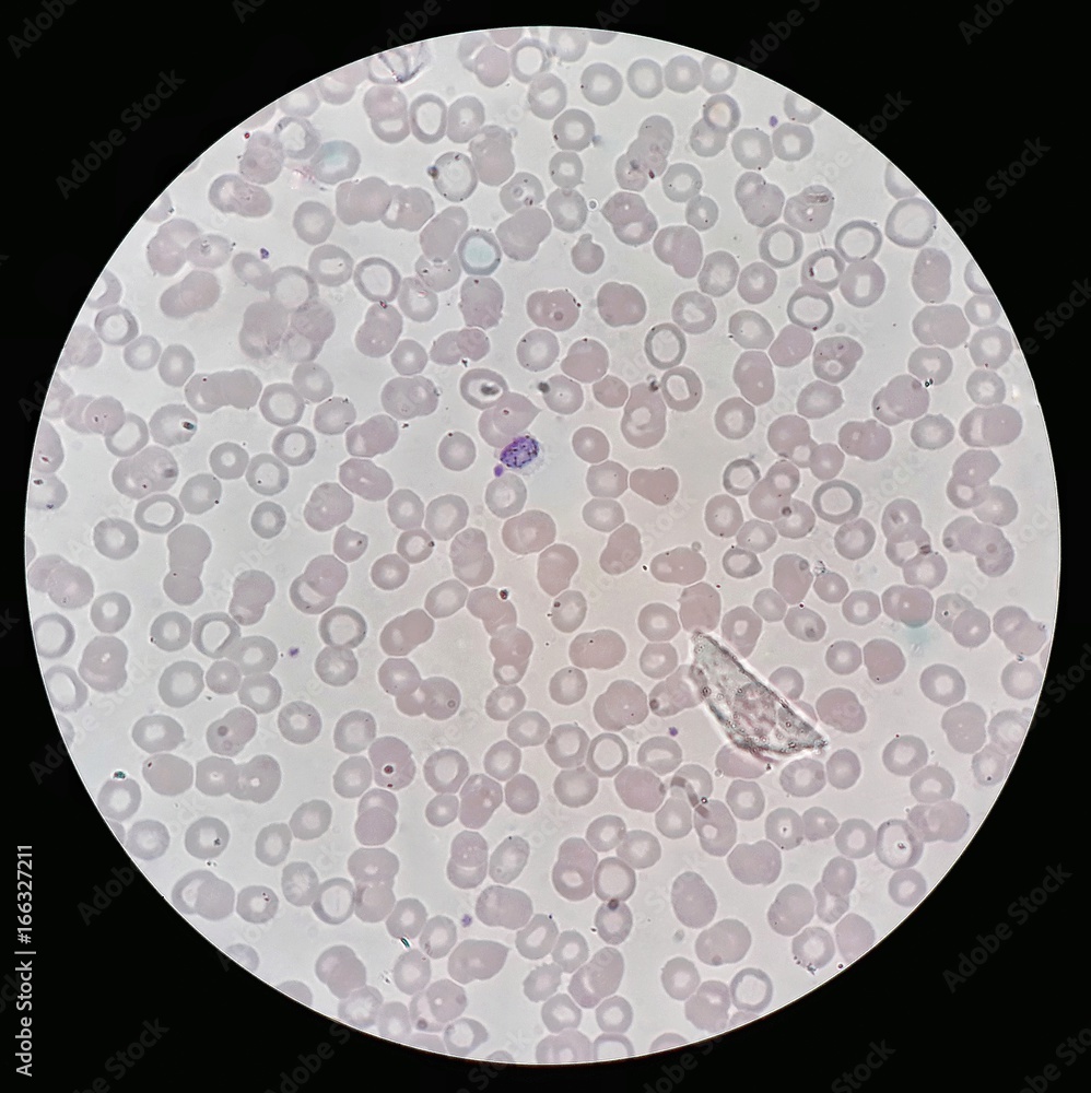 Under 100X light microscope, human parasite on thin film of blood smear ...