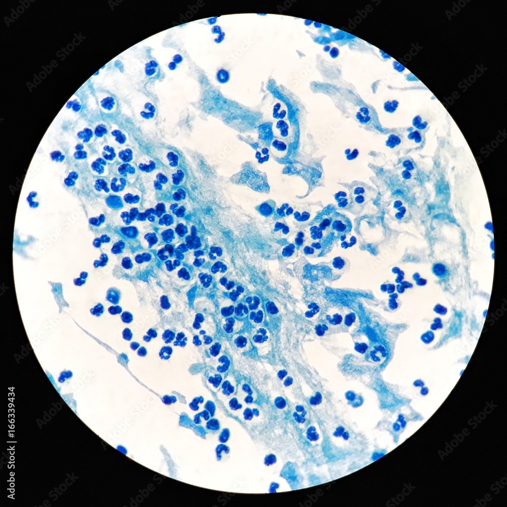 Smear of Acid-Fast bacilli (AFB) stained from sputum specimen with ...