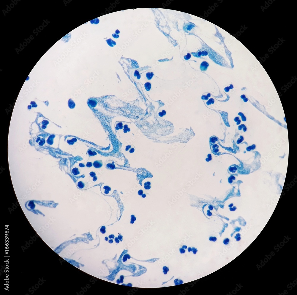 Smear of Acid-Fast bacilli (AFB) stained from sputum specimen with ...
