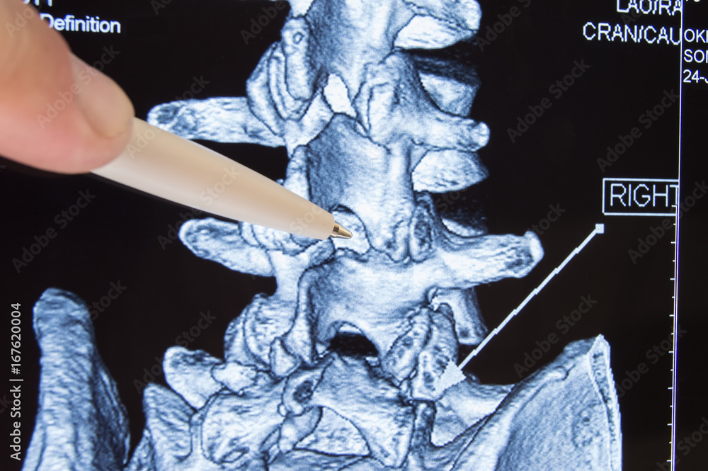 Doctor shows on CT MRI scans place in spine between vertebrae, which is ...