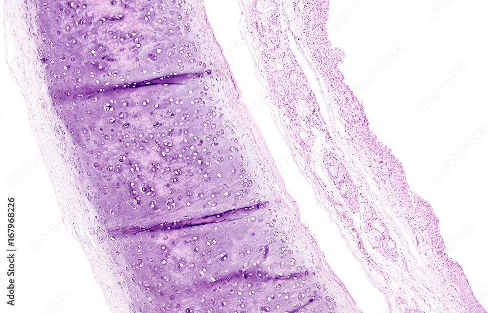 Histology of human tissue, show tracheitis and squamous metaplasia of ...