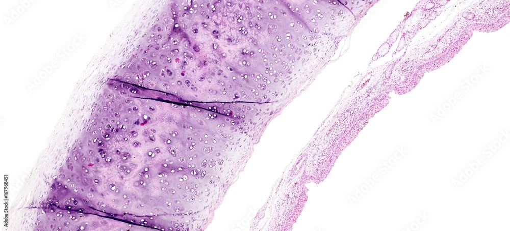 Histology of human tissue, show tracheitis as seen under the microscope ...