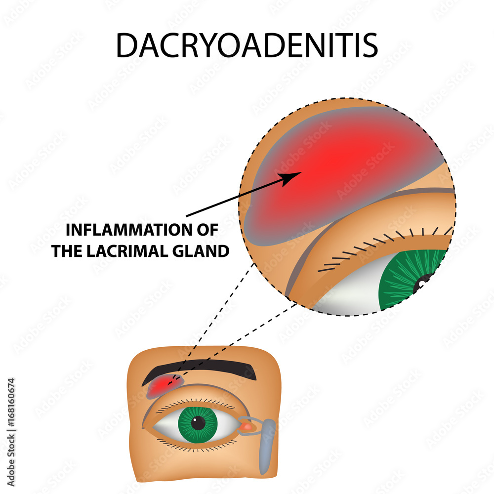 Dacryoadenitis. Inflammation of the lacrimal gland. The structure of ...
