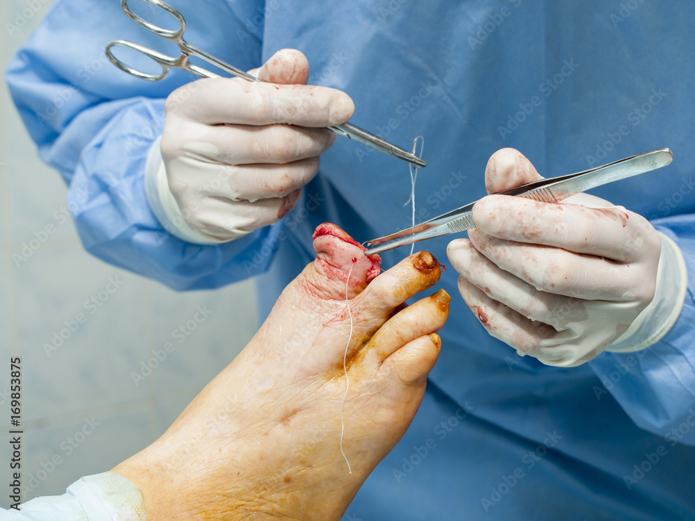 Diabetic foot syndrome. Gangrene of the big toe. Amputation of the big ...